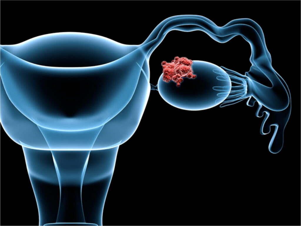 Epithelial Ovarian Carcinoma Samples - Bay Biosciences, LLC.