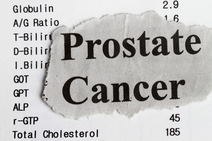 Prostate Cancer FFPE and Matched Plasma Samples for Research - Bay ...