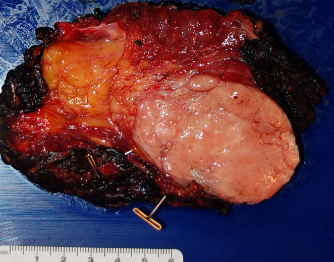 Cancer Solid Tumor Samples - Bay Biosciences, LLC.