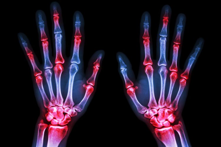 Rheumatoid Arthritis Plasma Samples - Bay Biosciences, LLC.