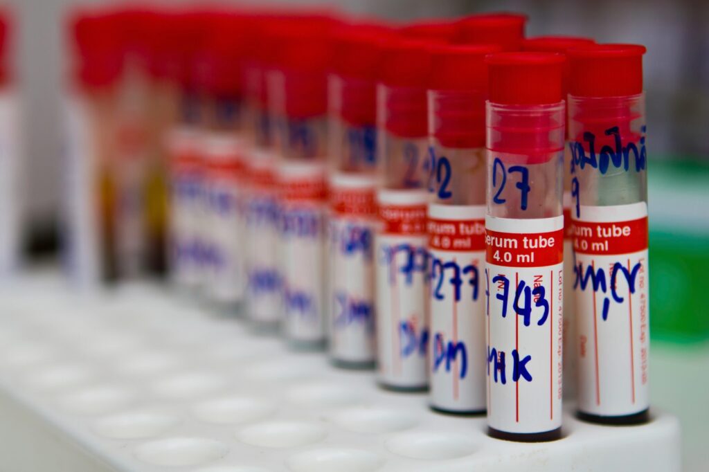 Creatine Kinase (CK) Test: Uses, Levels, and Clinical Significance