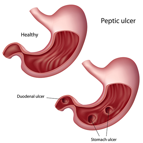 What are the Symptoms and Causes of Stomach Ulcers? - Bay Biosciences