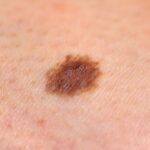 Skin Cancer Samples for Research in Drug Discovery